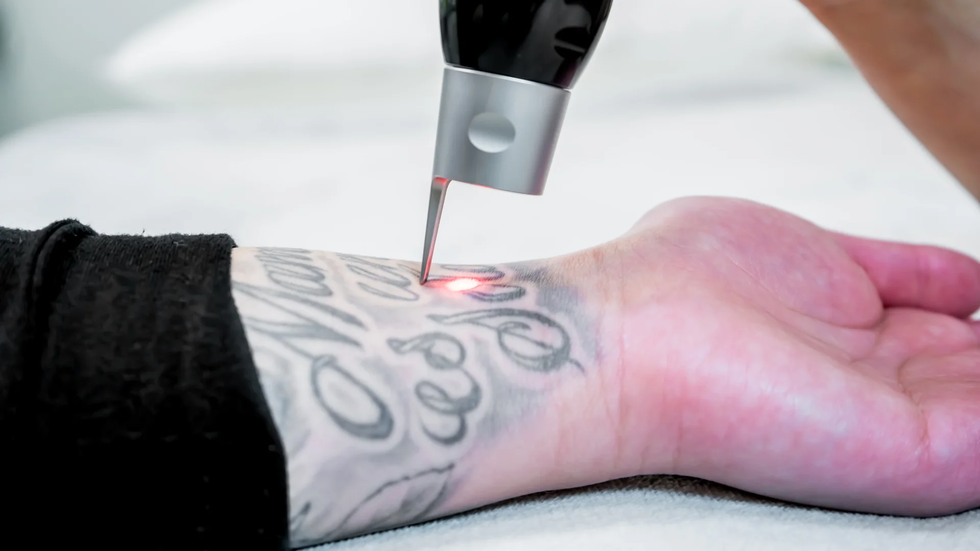 Surgical Excision Of Tattoo And Skin Grafting Ko Cosmetic Surgery Centre 7095