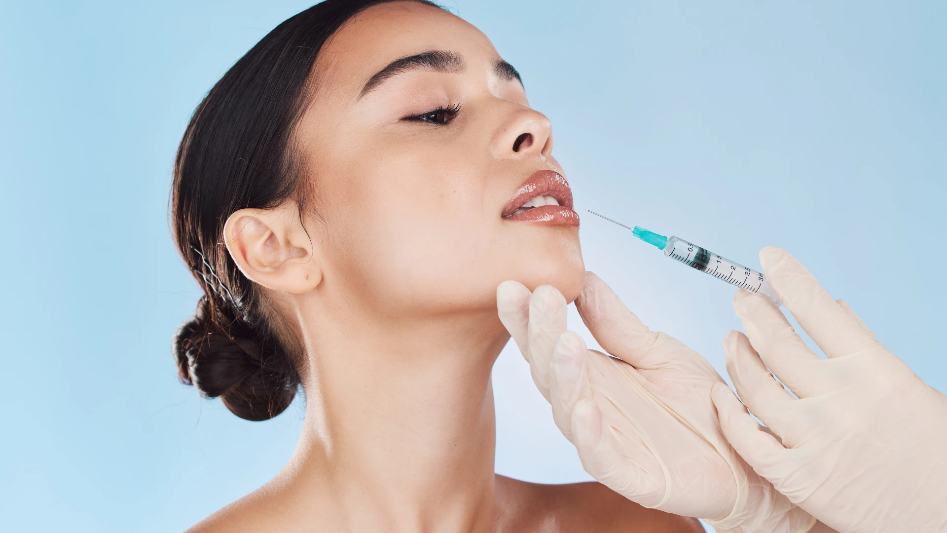 Upper Lip Lift Surgery in Coimbatore: Subnasal & V-Y Plasty Lip ...