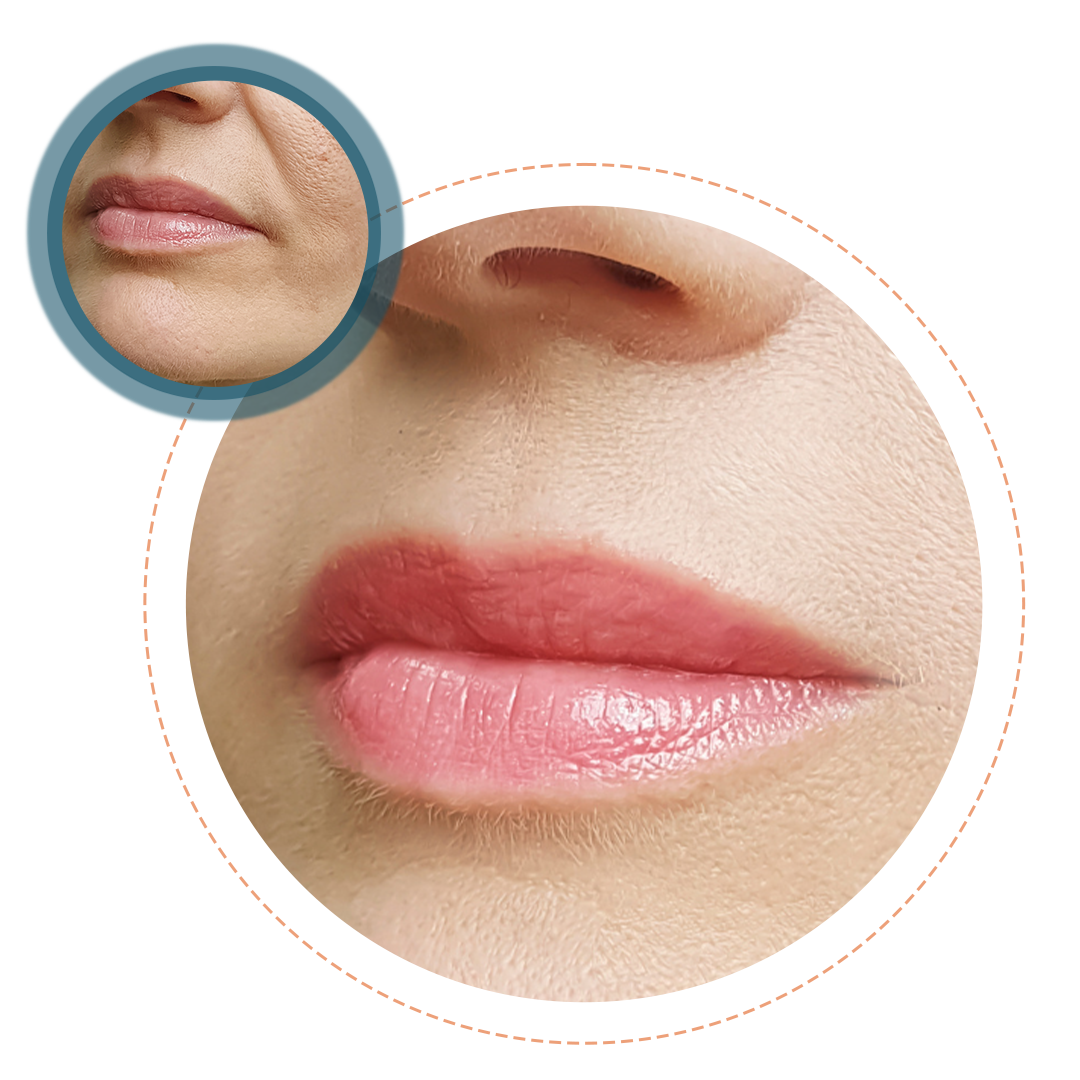 Corner Lip Lift Surgery in Coimbatore: Correct Downturned Mouth Corners ...